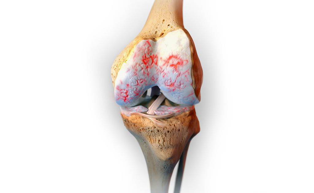 Behandlung der Knie-Arthrose ohne Medikamente - Wie-funktioniert.com